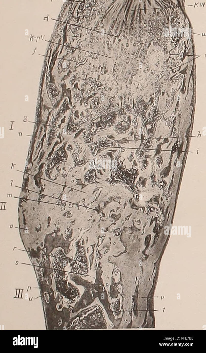 Rachitis hi-res stock photography and images - Alamy