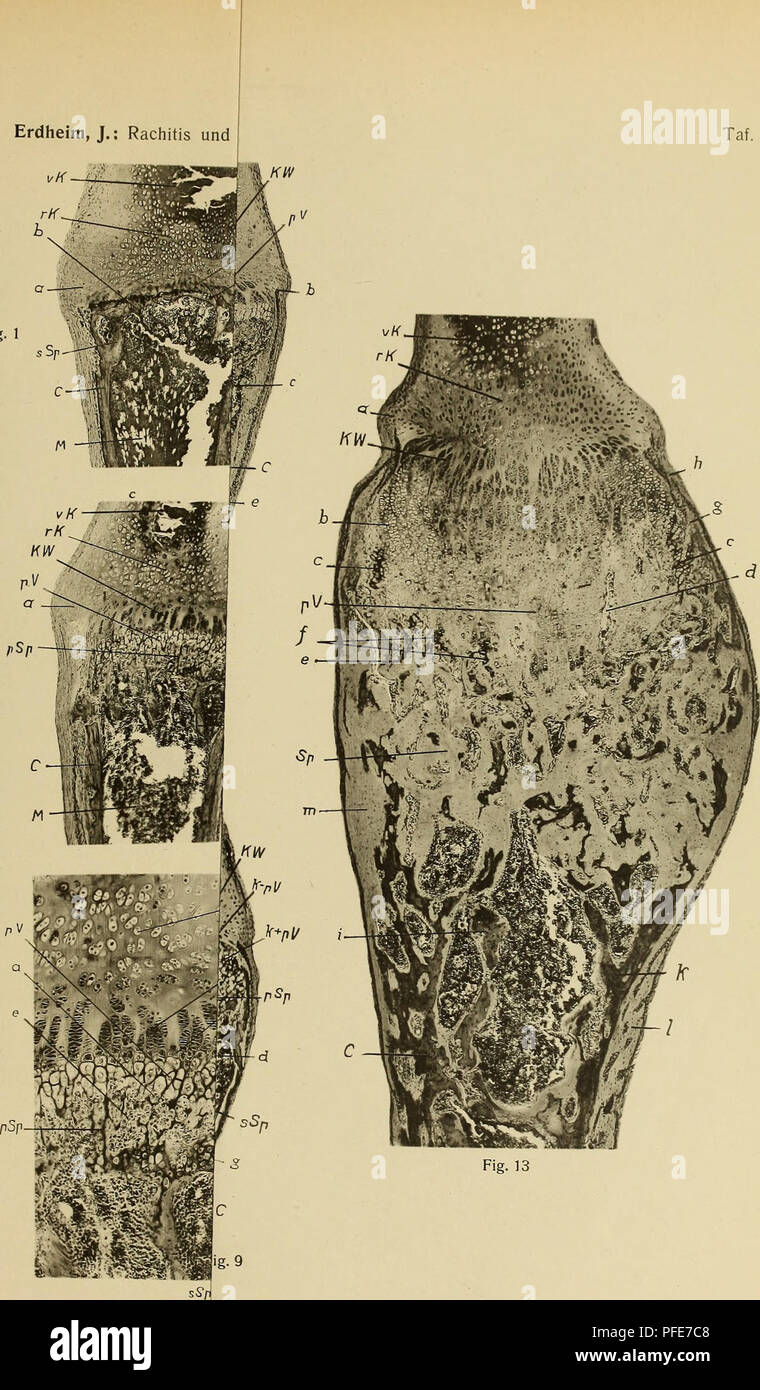 Rachitis hi-res stock photography and images - Alamy