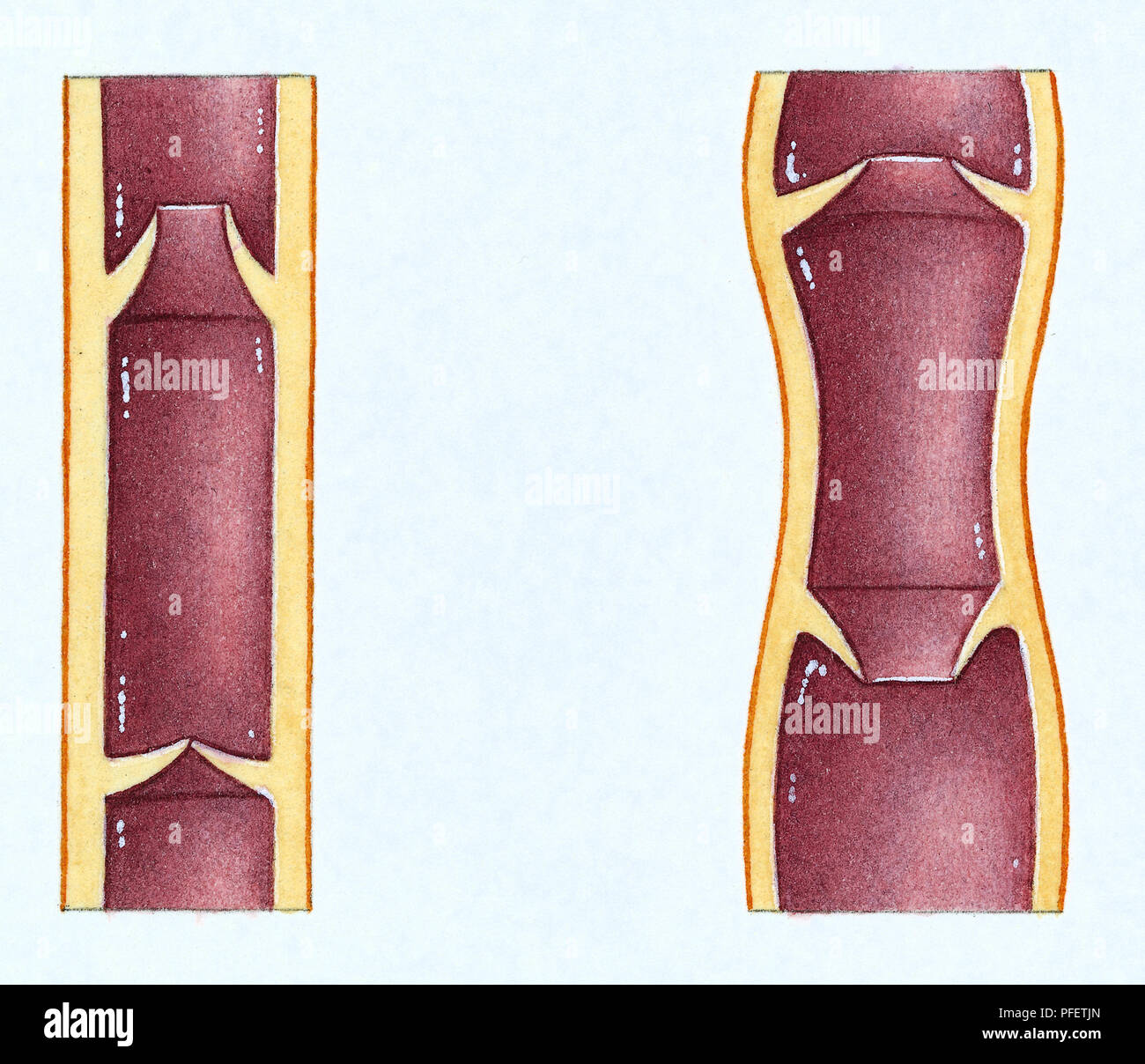 Two illustrations showing the flow of blood in a healthy vein and a ...