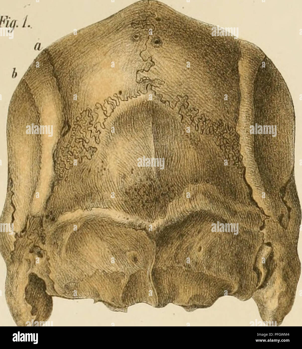 Cranial abnormalities hi-res stock photography and images - Alamy
