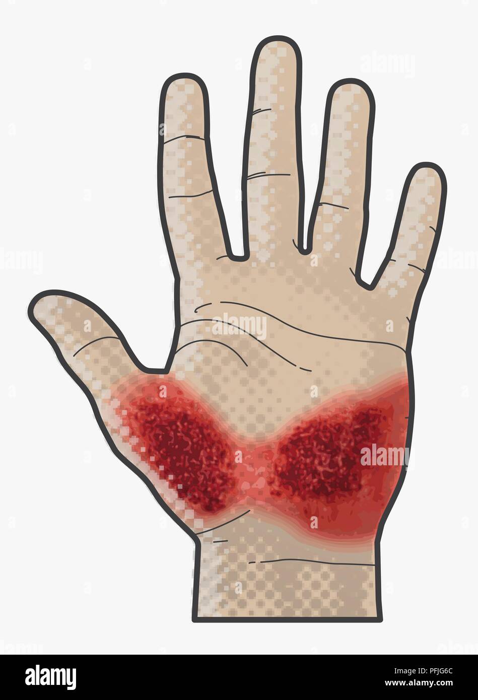 Digital illustration of bleeding wound on palm of hand Stock Photo - Alamy