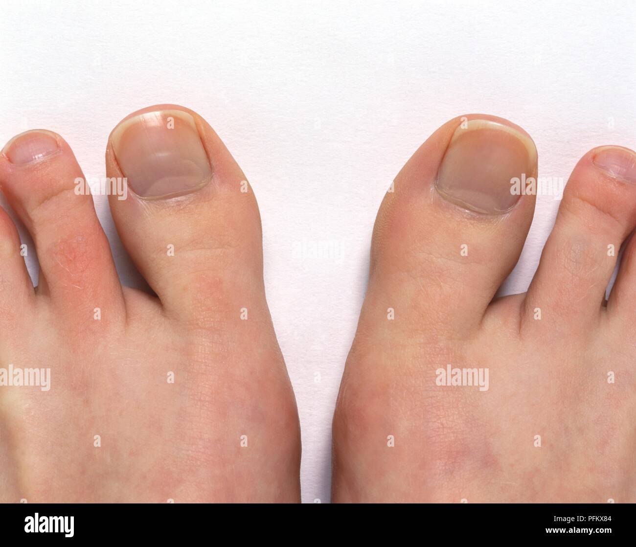 Close-up of young woman's cut toenails Stock Photo - Alamy