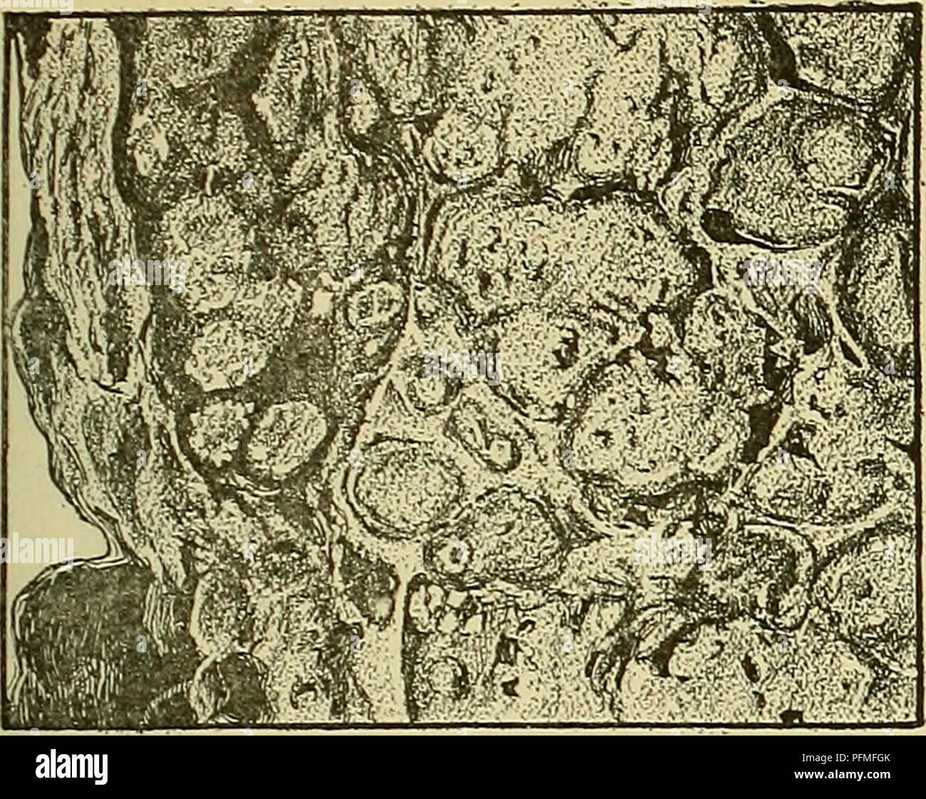 Lung calcification hi-res stock photography and images - Alamy