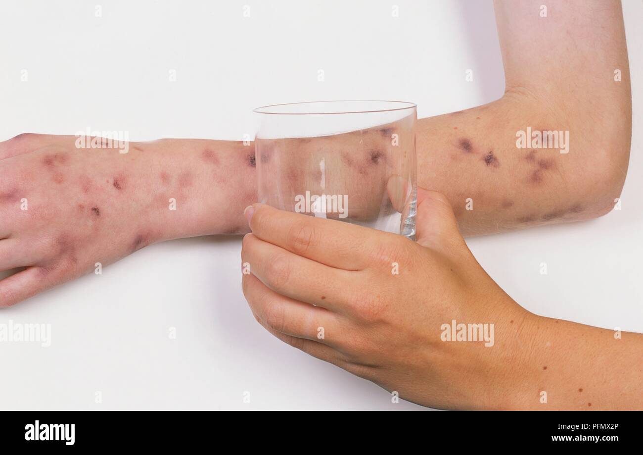 Meningitis rash hi-res stock photography and images - Alamy