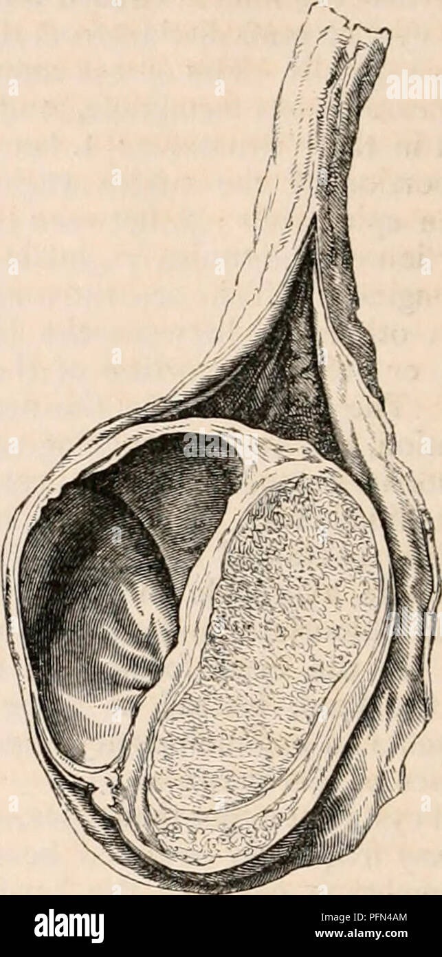 Hydrocele hi-res stock photography and images - Alamy