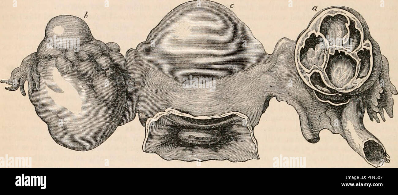 Simple cysts hi-res stock photography and images - Alamy