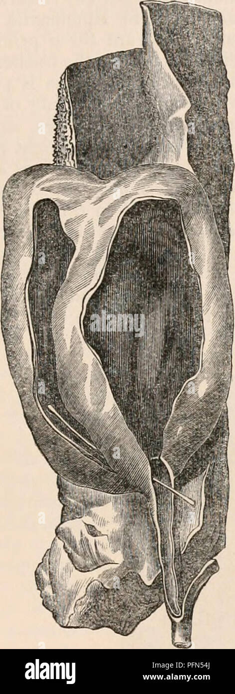 Bladder cyst hi-res stock photography and images - Alamy