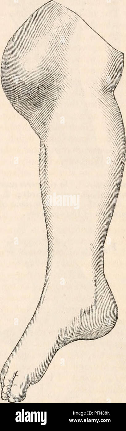 This anatomical entry discusses the formation of an abscess in the ...