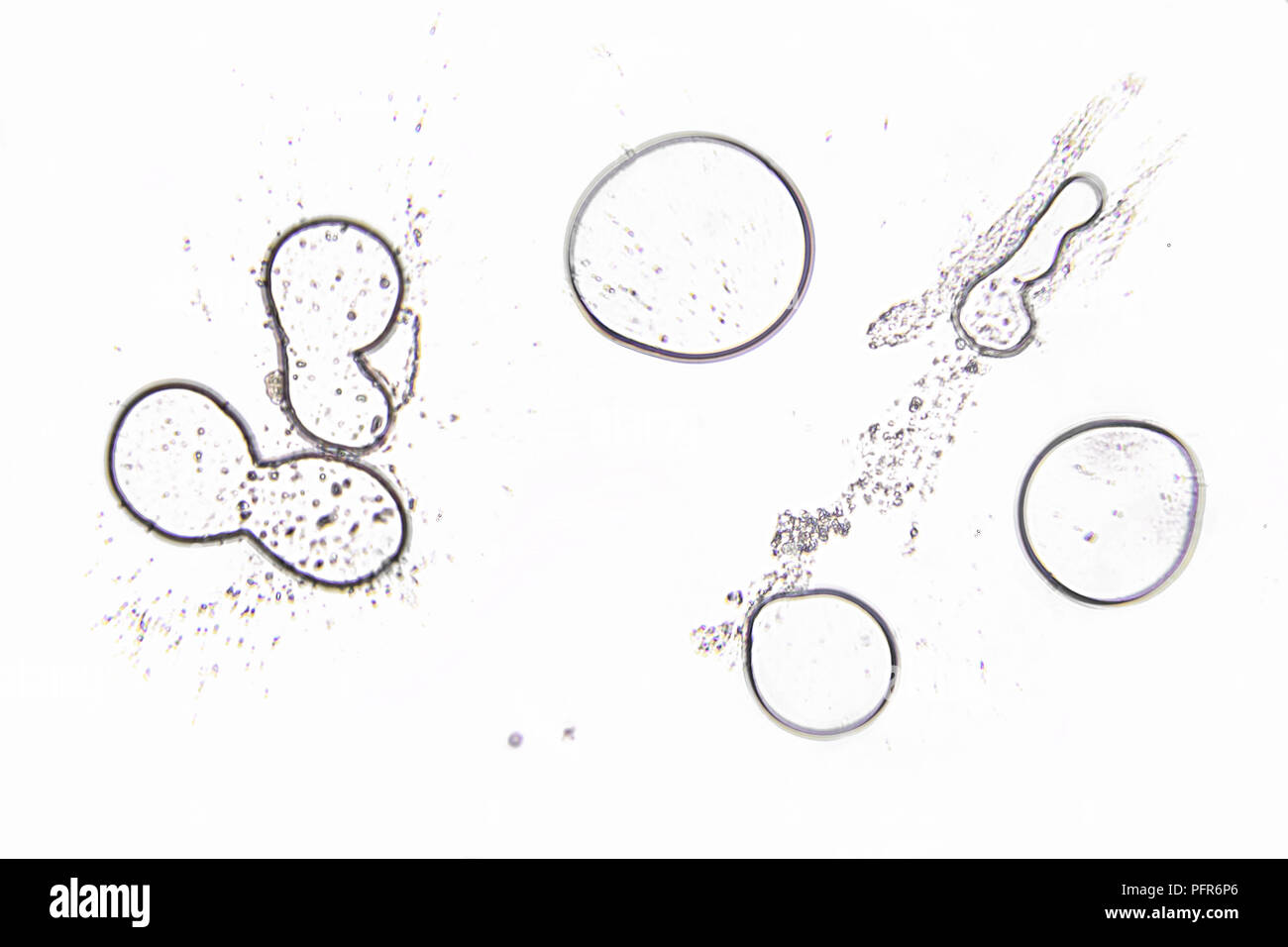 Cells in a urine sample where a urinary tract infection, or UTI, is ...