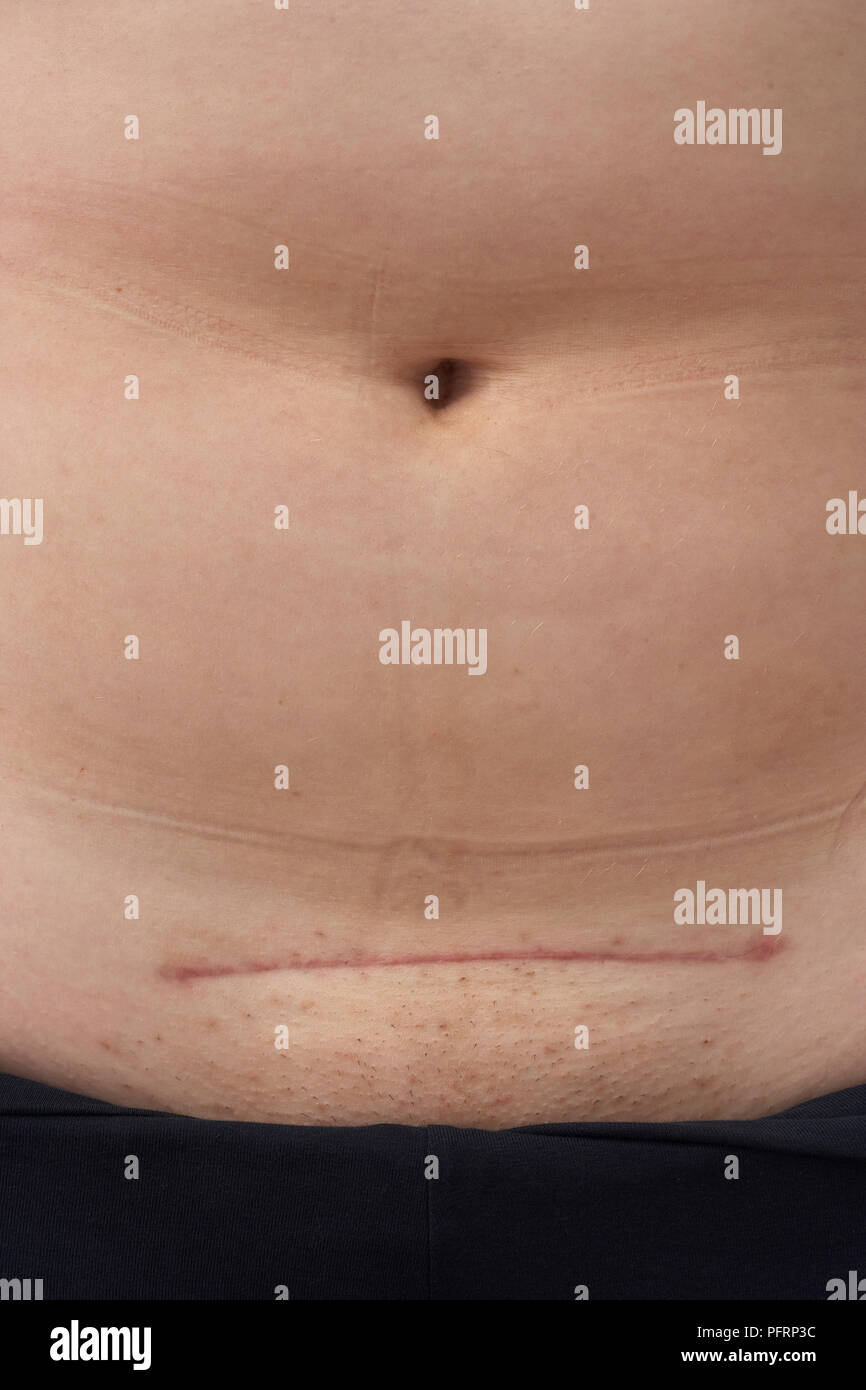 Caesarean scar, close-up Stock Photo - Alamy