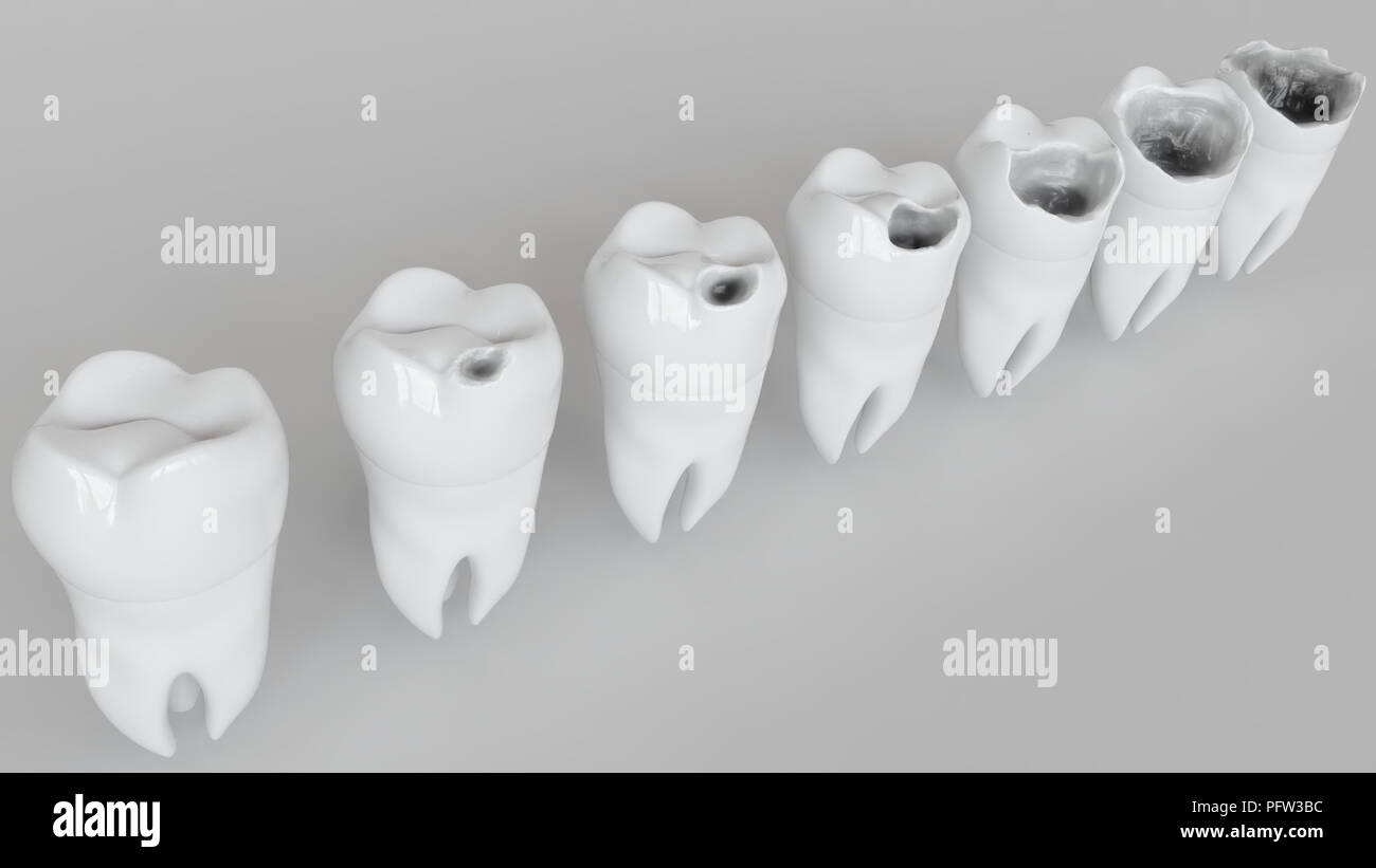 The stages of caries on the molar - 3D Rendering Stock Photo - Alamy