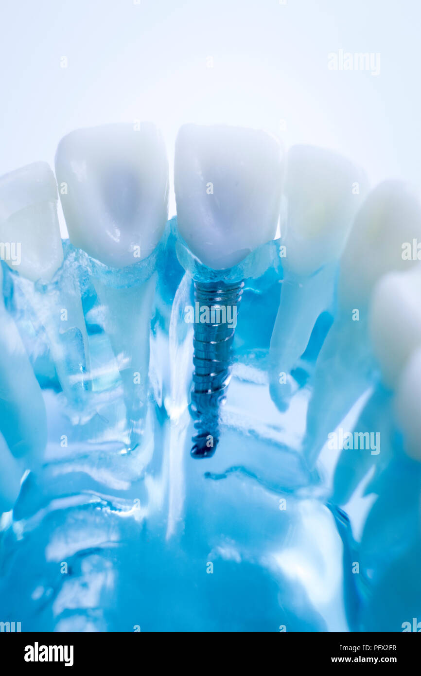 Dentist dental teeth teaching model showing titanium metal tooth ...