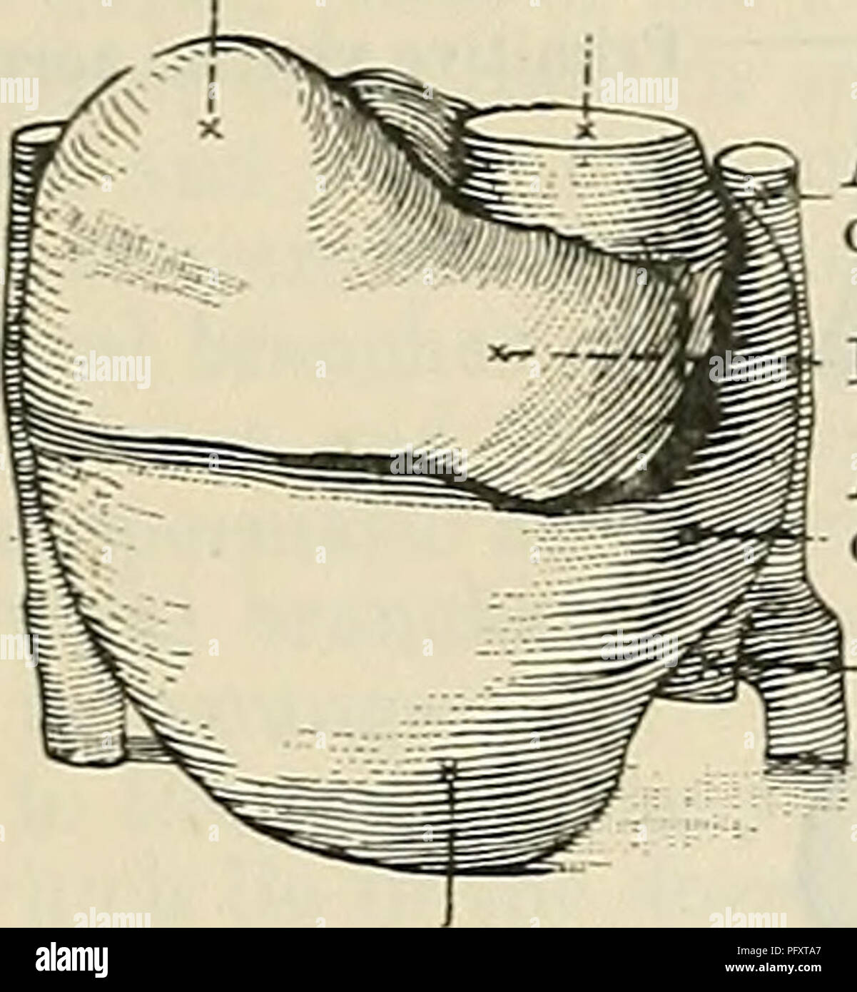 Coronary sinus hi-res stock photography and images - Alamy