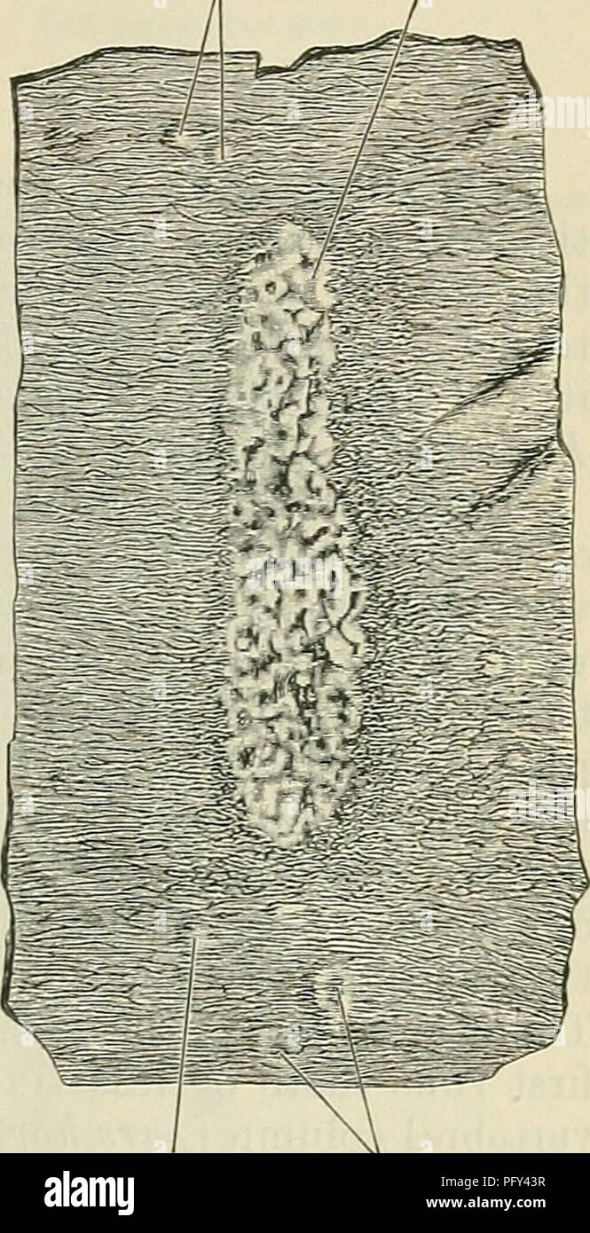 Lymph Nodules High Resolution Stock Photography and Images - Alamy