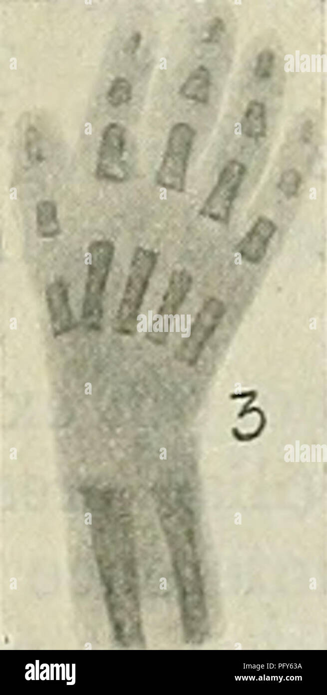 . Cunningham's Text-book of anatomy. Anatomy. Head Base Metacarpal Fig ...