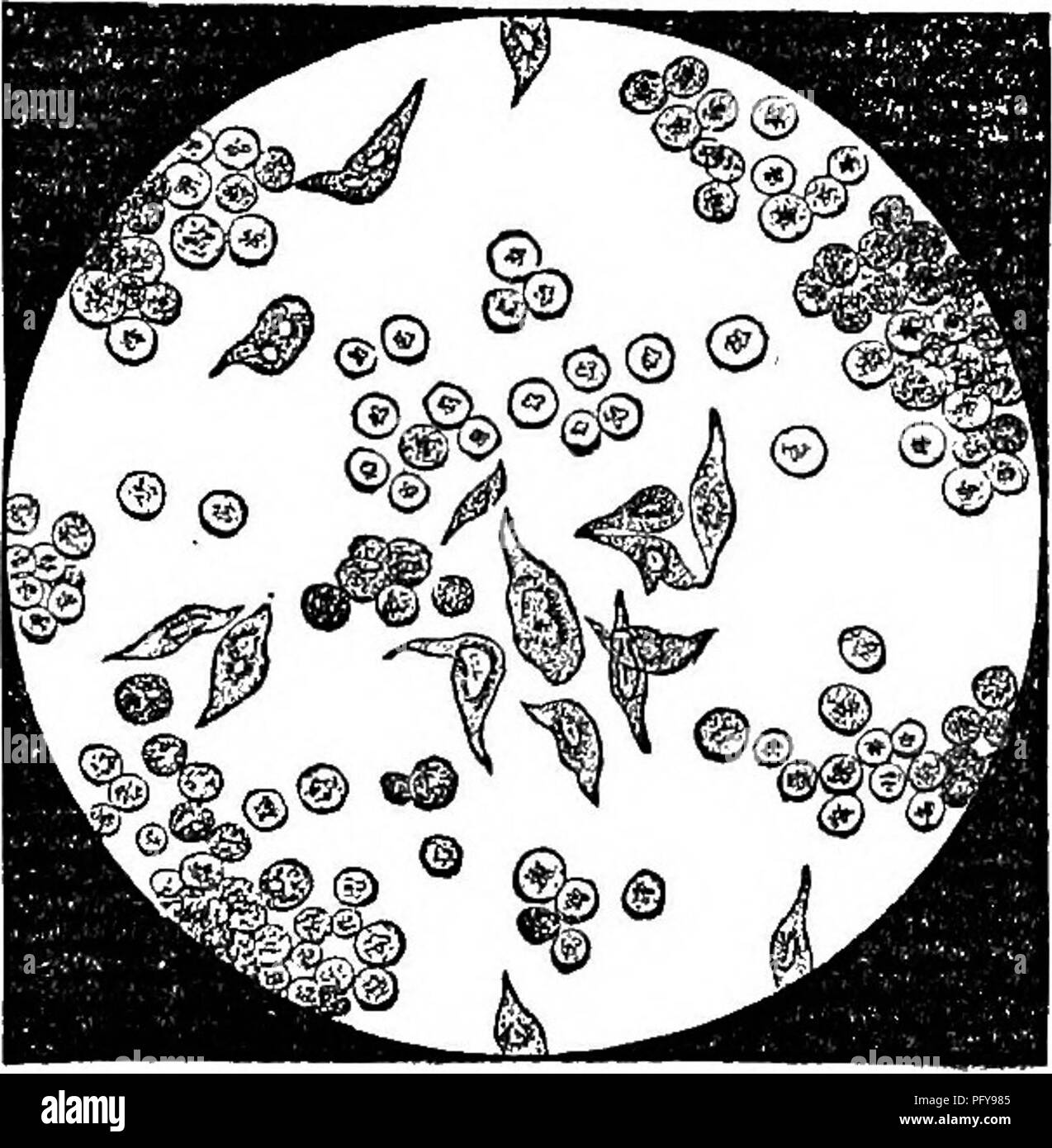 Pus cells hi-res stock photography and images - Alamy