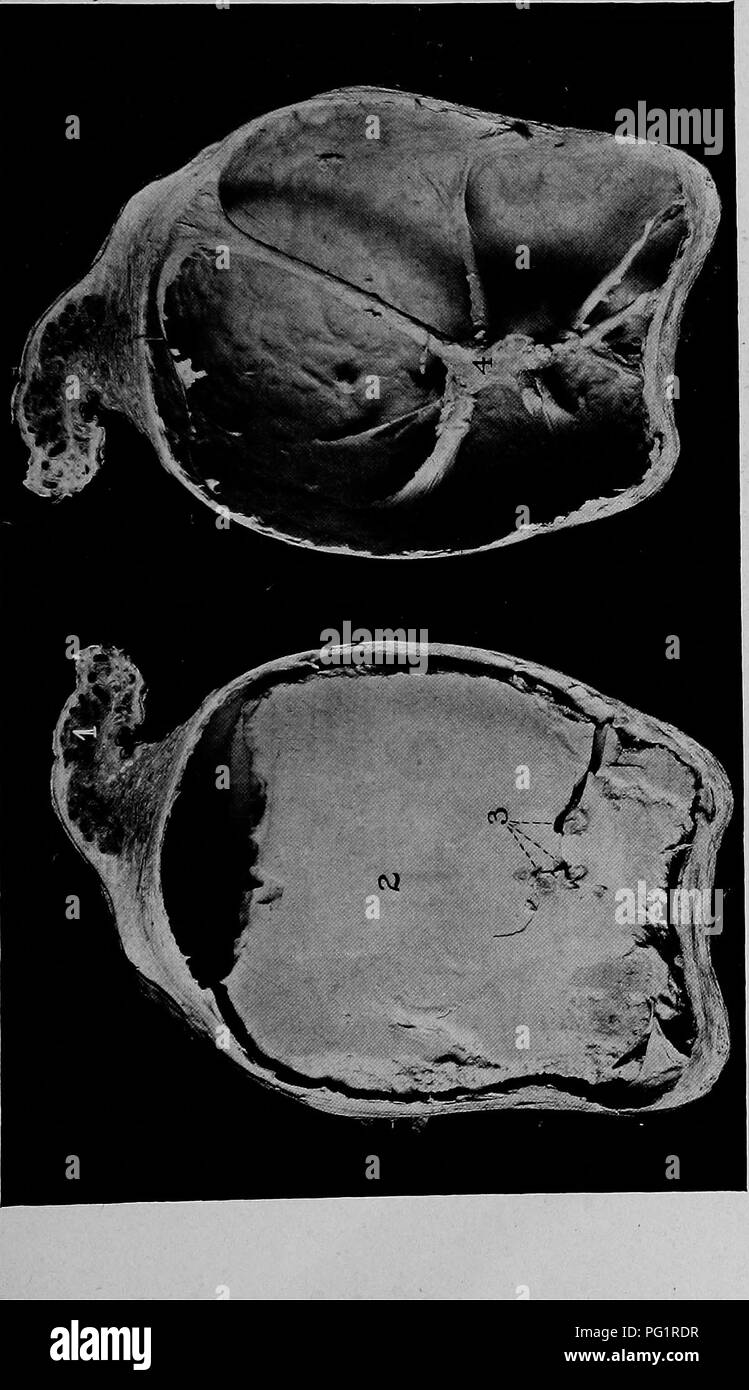 Orchitis hi-res stock photography and images - Alamy
