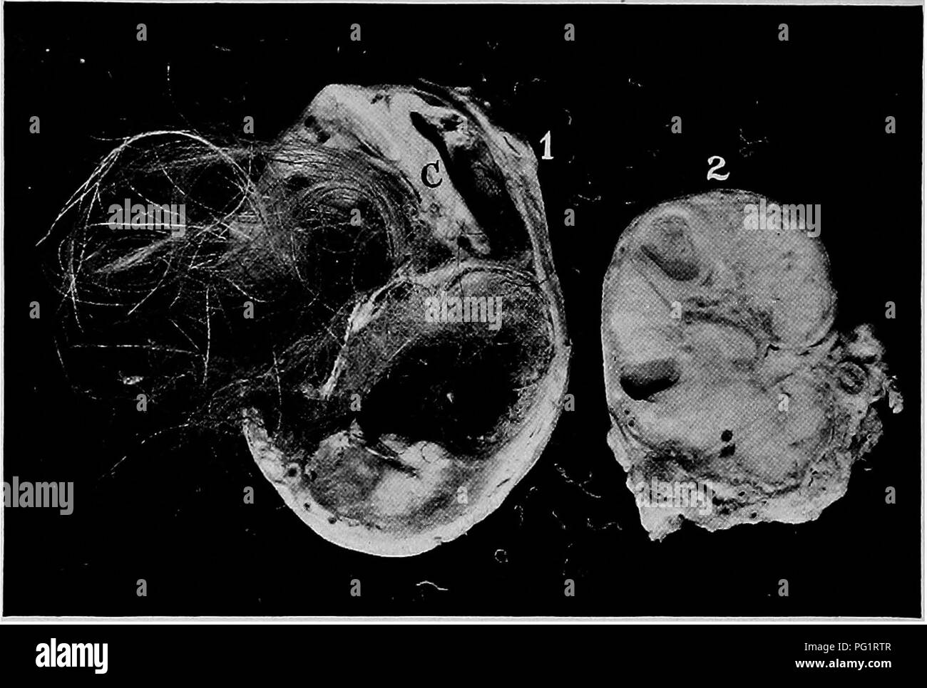 Dermoid cyst hi-res stock photography and images - Alamy