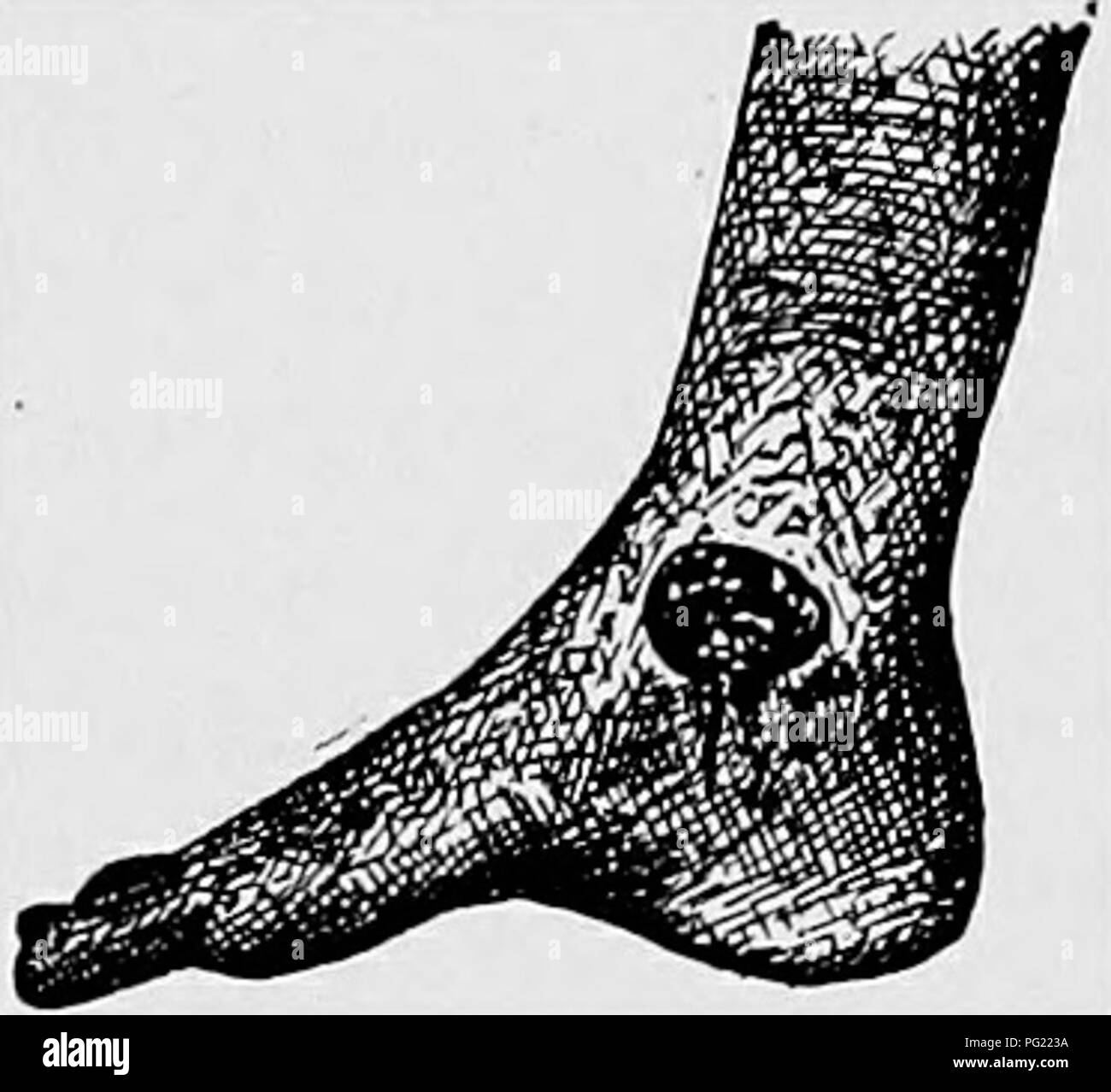 This illustration represents the tropical ulcer, a disease linked to ...