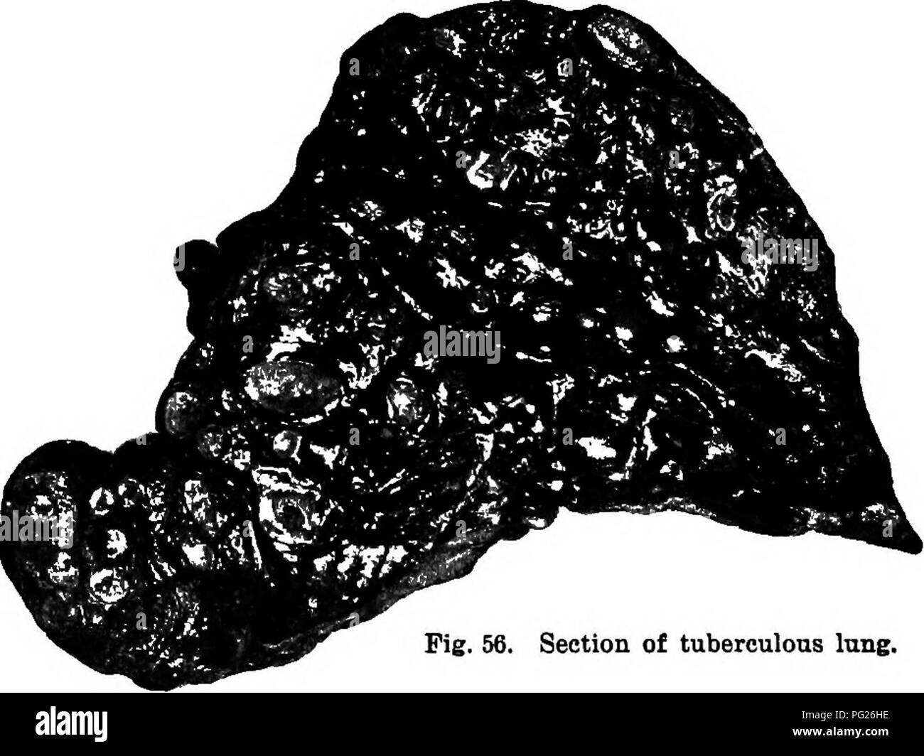 Tuberculosis bacteria, illustration Black and White Stock Photos ...