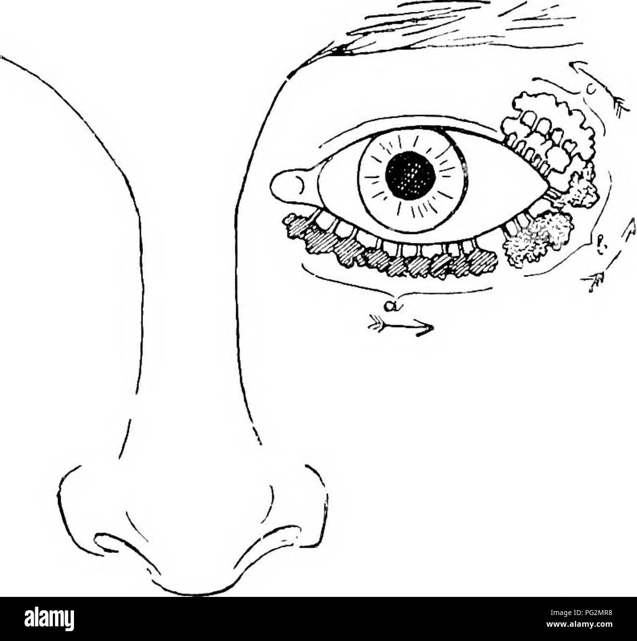 Meibomian gland hi-res stock photography and images - Alamy