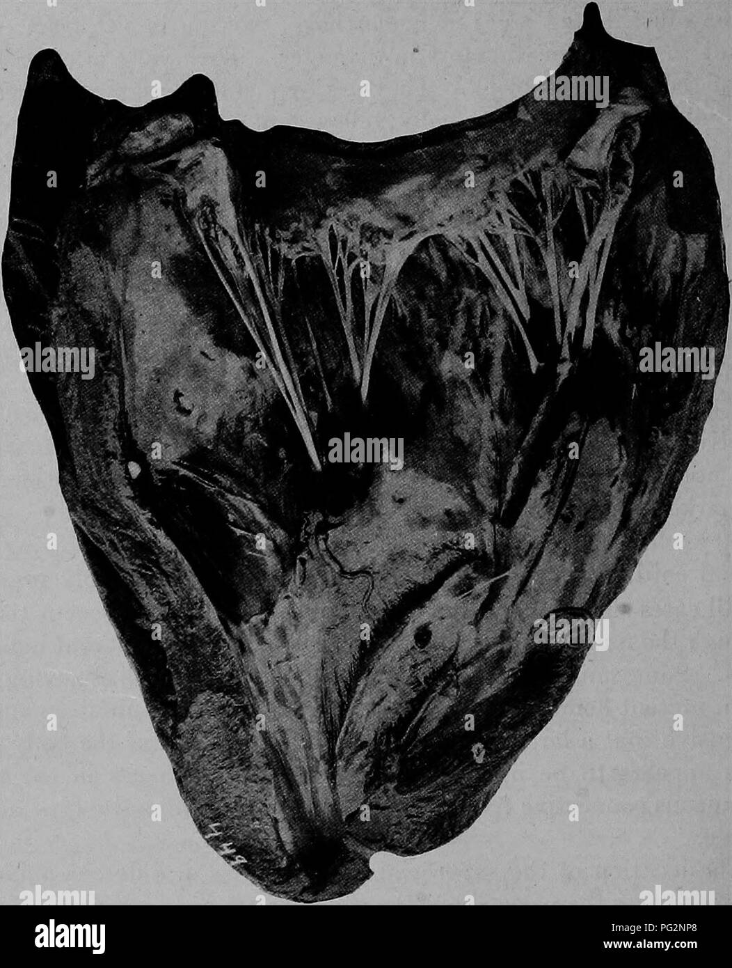 Septicemia High Resolution Stock Photography and Images - Alamy