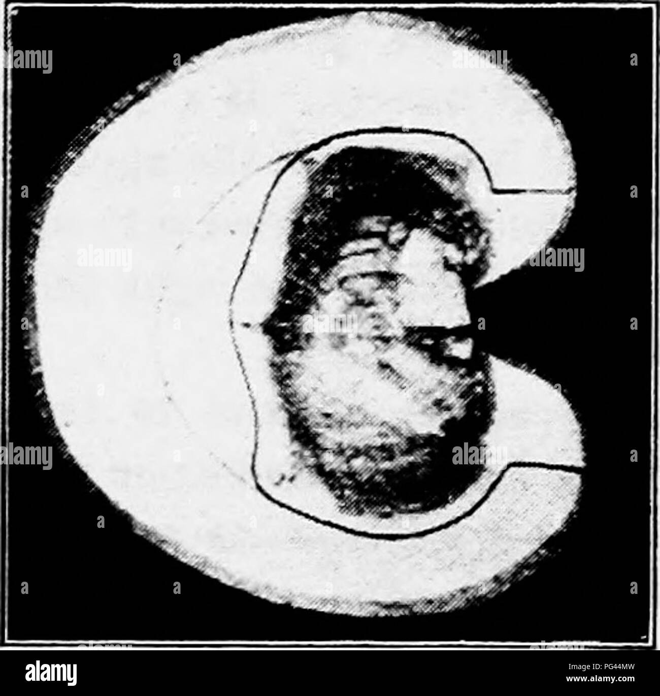 Callus growth hi-res stock photography and images - Alamy