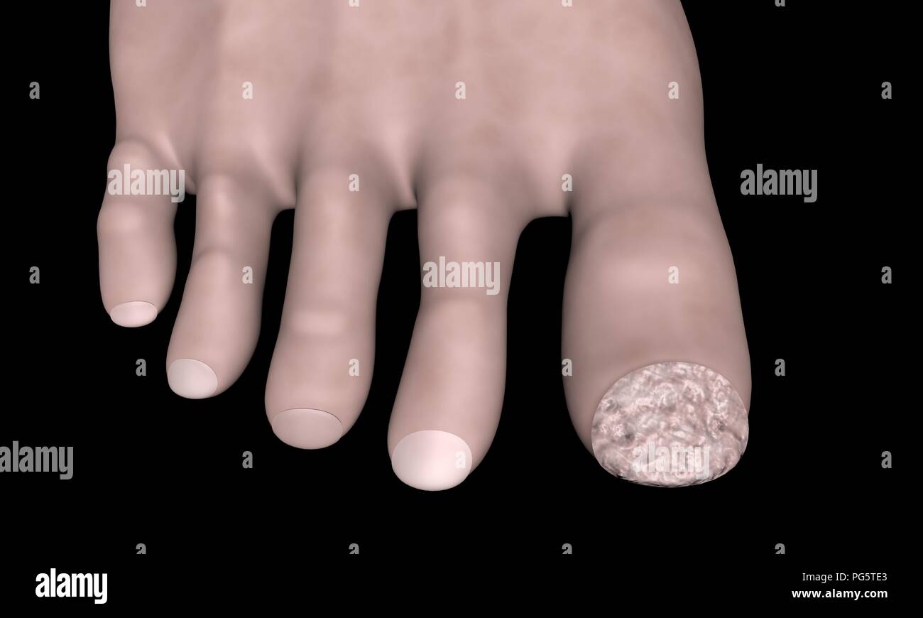 Toe nail with fungal infection. Before treatment. Infected toenail. 3d ...