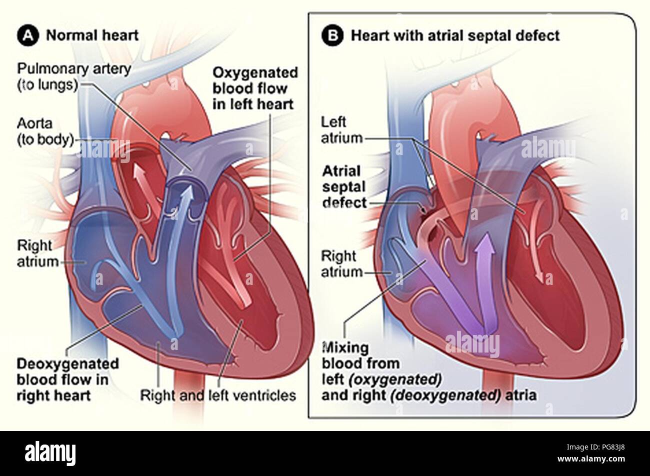 Atrial septal defect hi-res stock photography and images - Alamy
