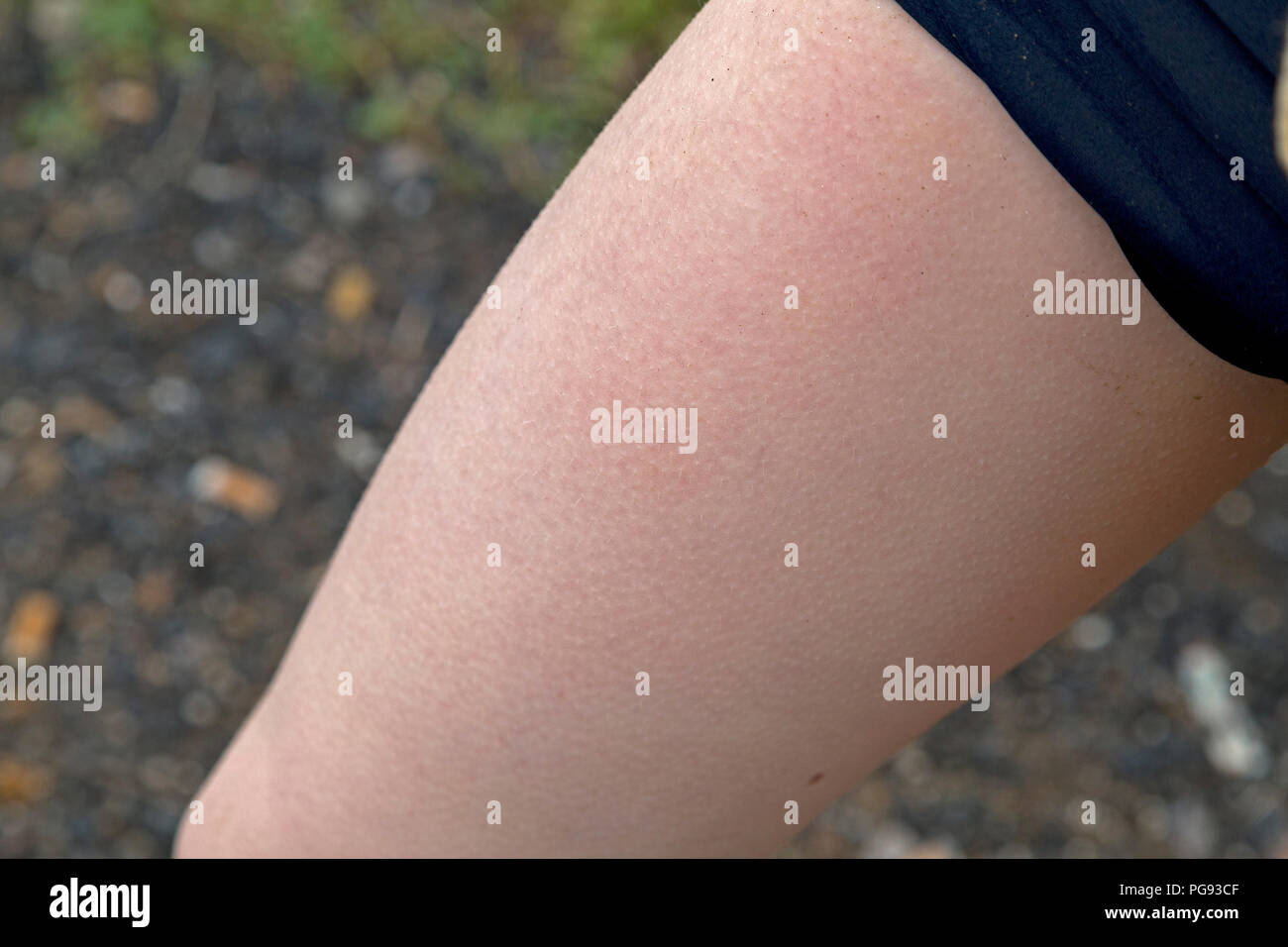 Child goose pimples hi-res stock photography and images - Alamy