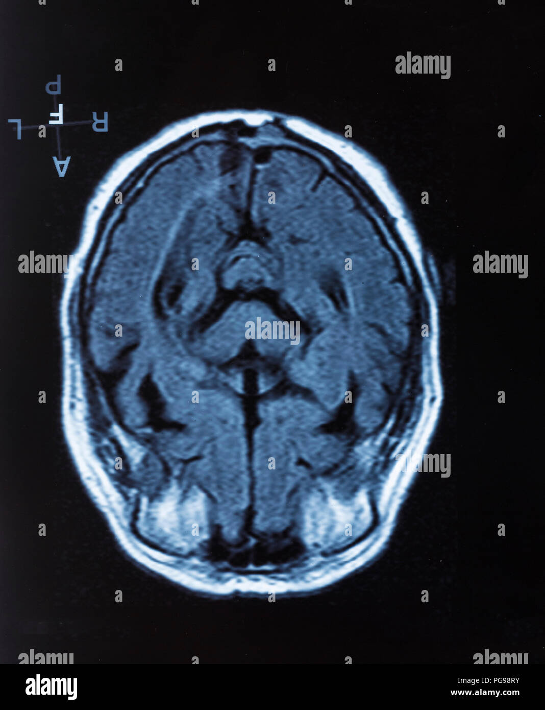 Human Brain Scan Mri Not Health High Resolution Stock Photography and Images - Alamy
