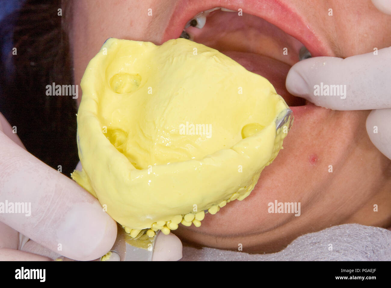 oral rehabilitation process, partial removable prosthesis Stock Photo ...