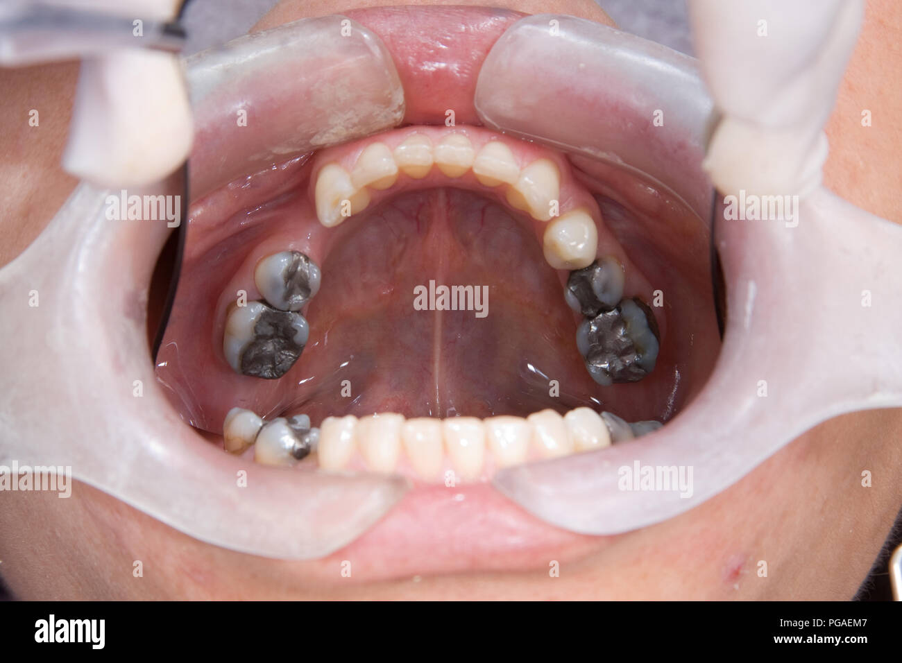 oral rehabilitation process, partial removable prosthesis Stock Photo ...
