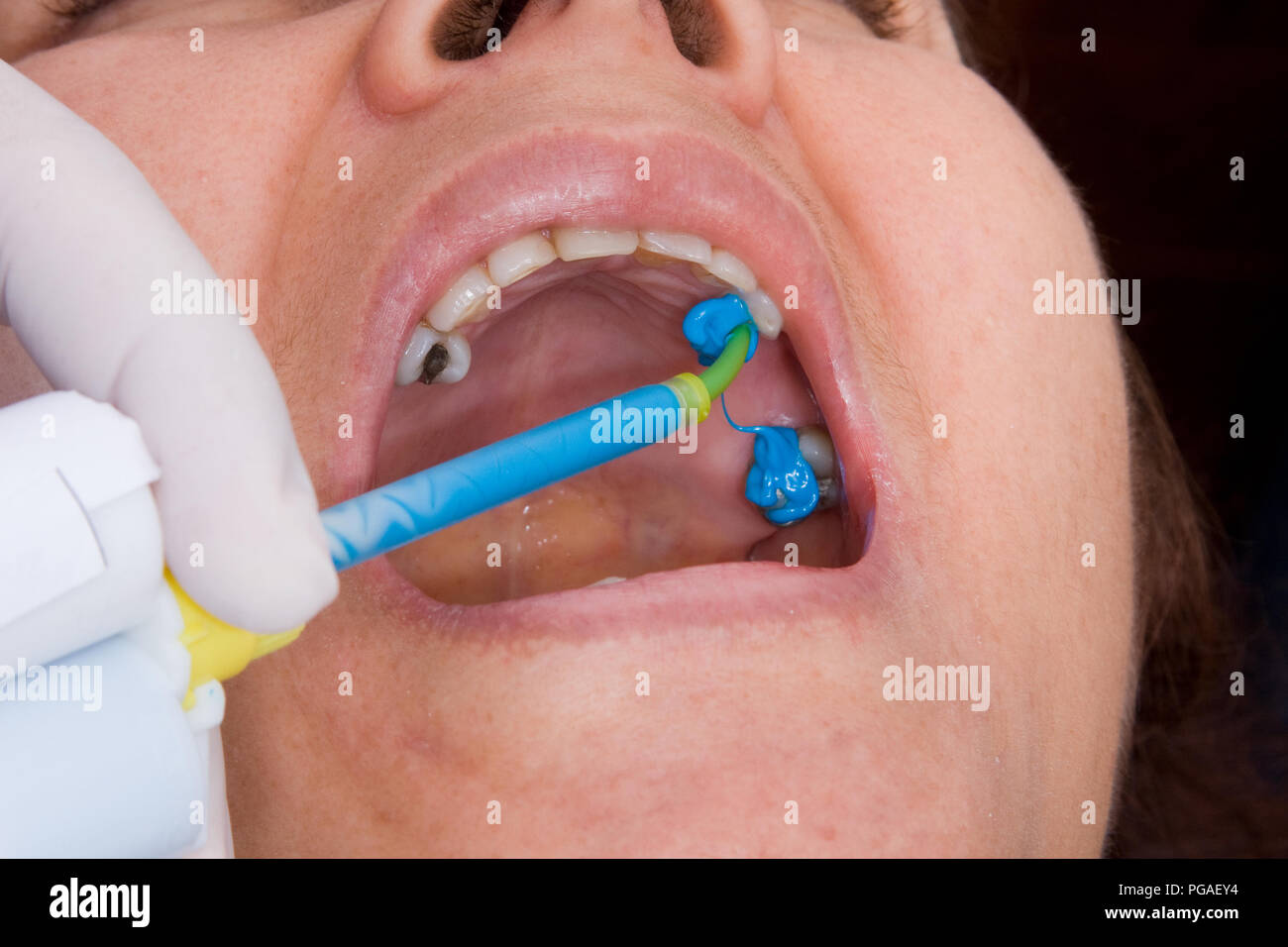 oral rehabilitation process, partial removable prosthesis Stock Photo ...