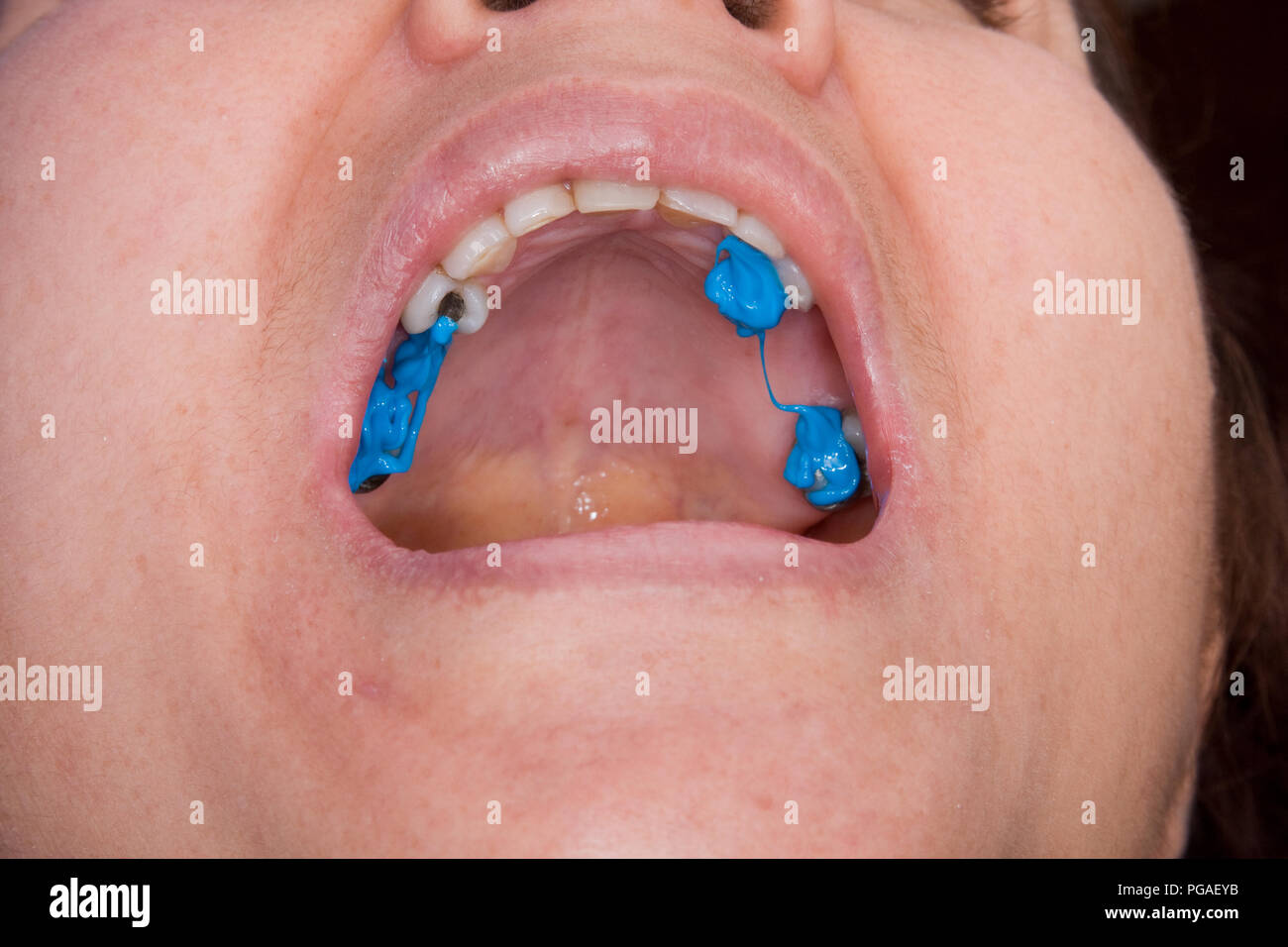 oral rehabilitation process, partial removable prosthesis Stock Photo ...