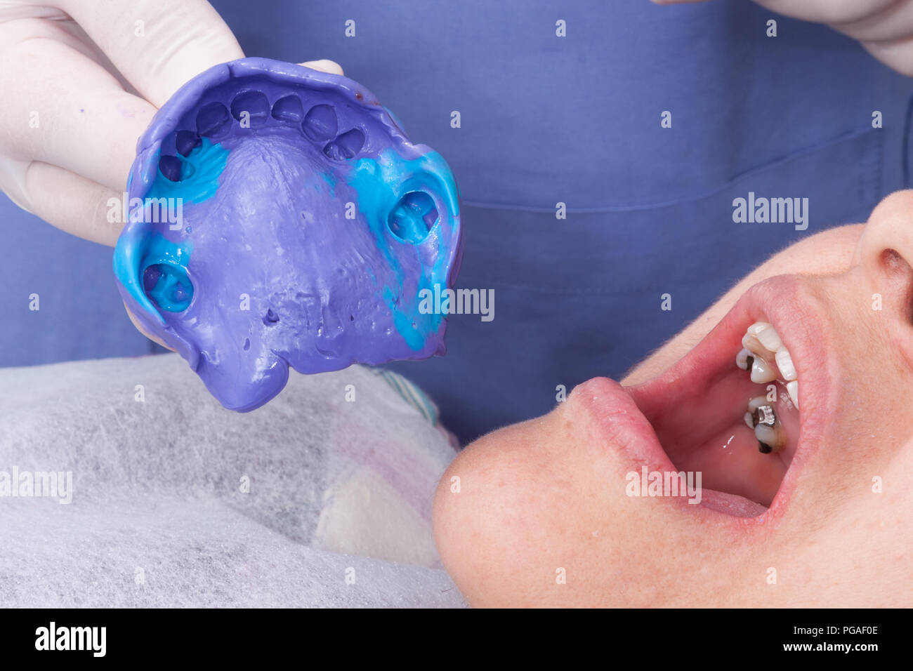 oral rehabilitation process, partial removable prosthesis Stock Photo ...