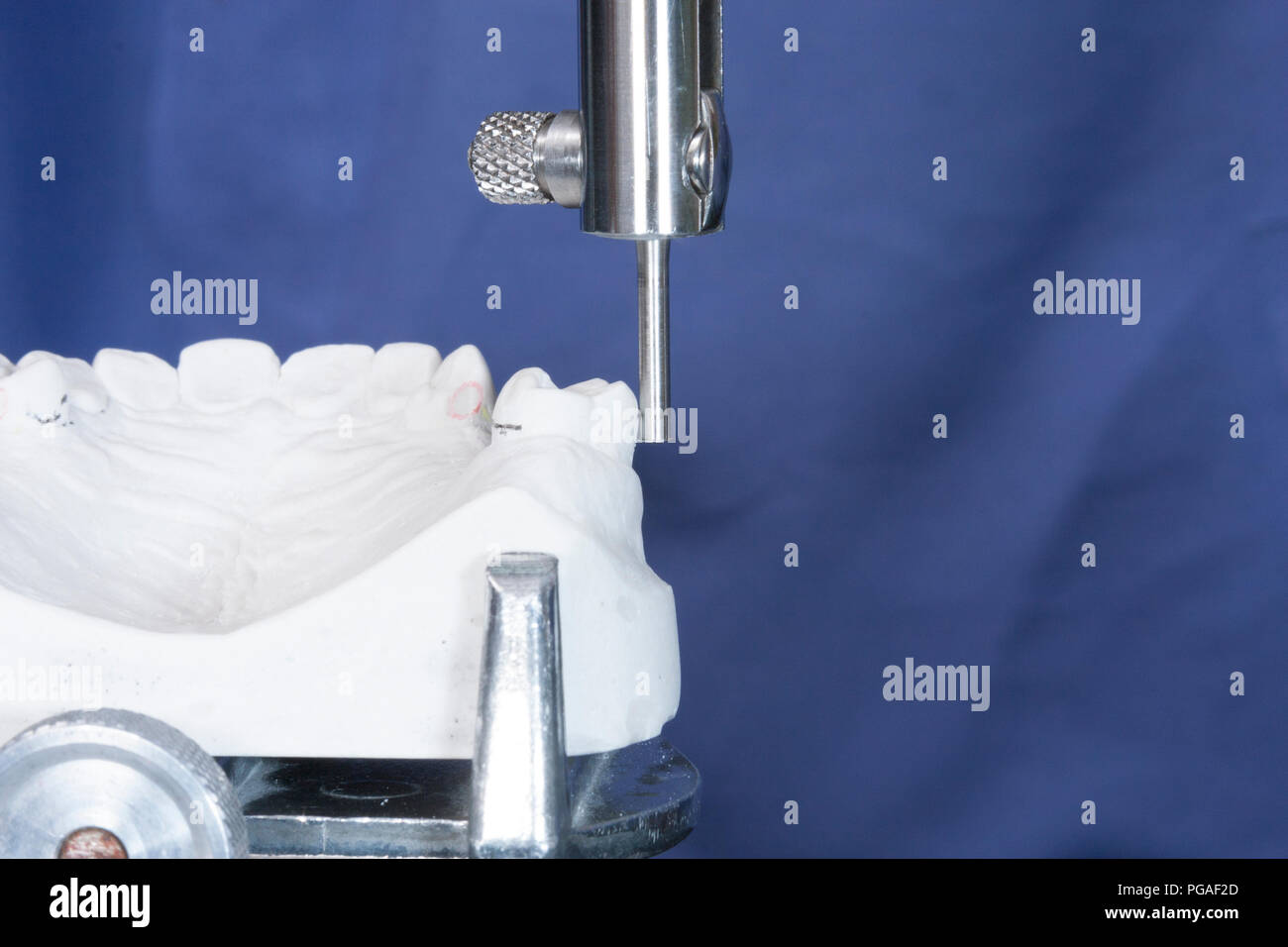 oral rehabilitation process, partial removable prosthesis Stock Photo ...