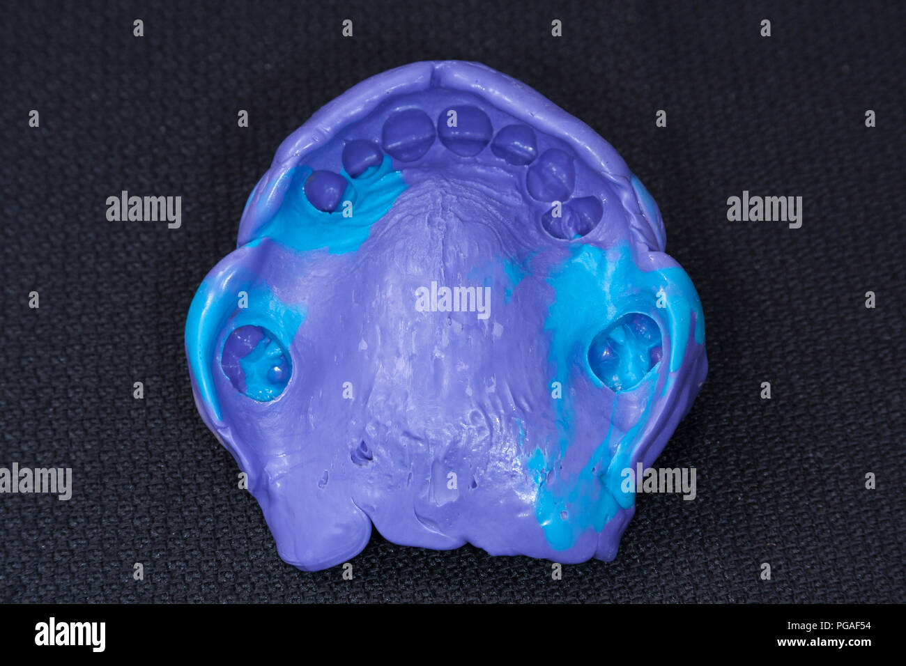 oral rehabilitation process, partial removable prosthesis Stock Photo ...