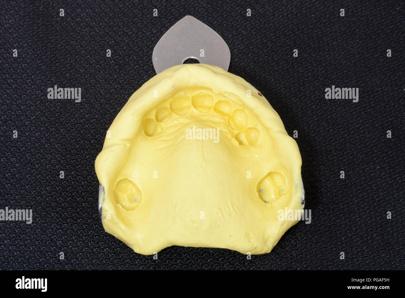 oral rehabilitation process, partial removable prosthesis Stock Photo ...