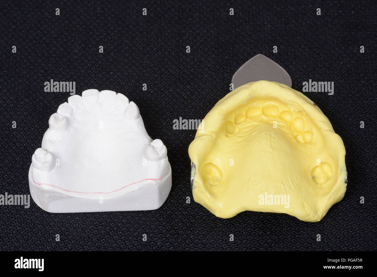 oral rehabilitation process, partial removable prosthesis Stock Photo ...