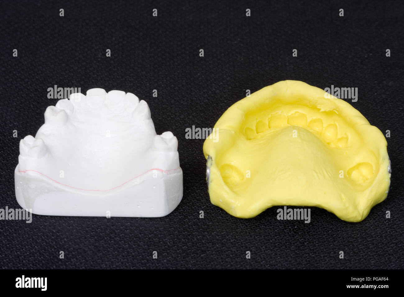 oral rehabilitation process, partial removable prosthesis Stock Photo ...