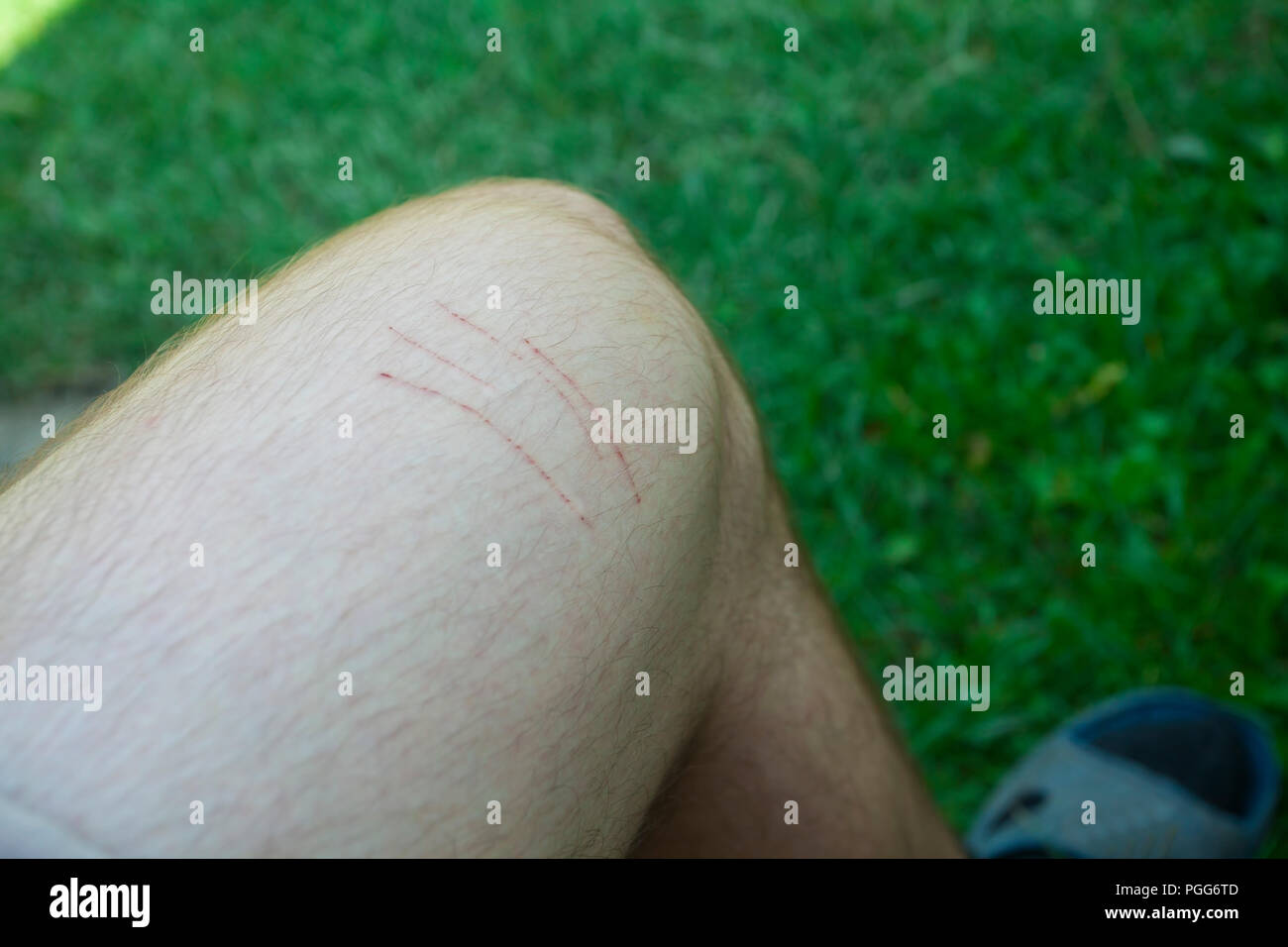 Bite scar hi-res stock photography and images - Alamy