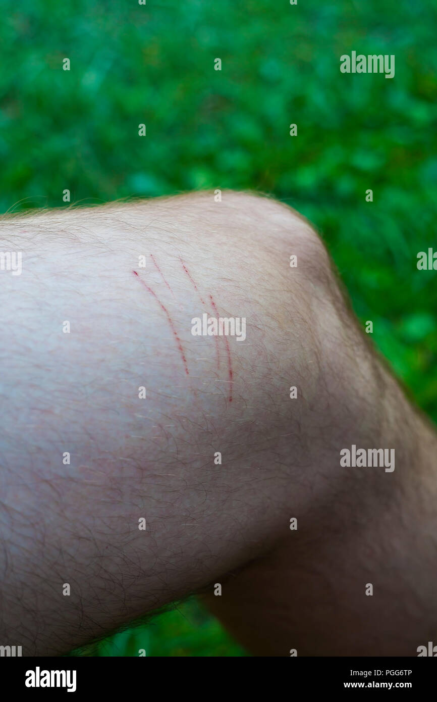 Cat scratch disease hi-res stock photography and images - Alamy