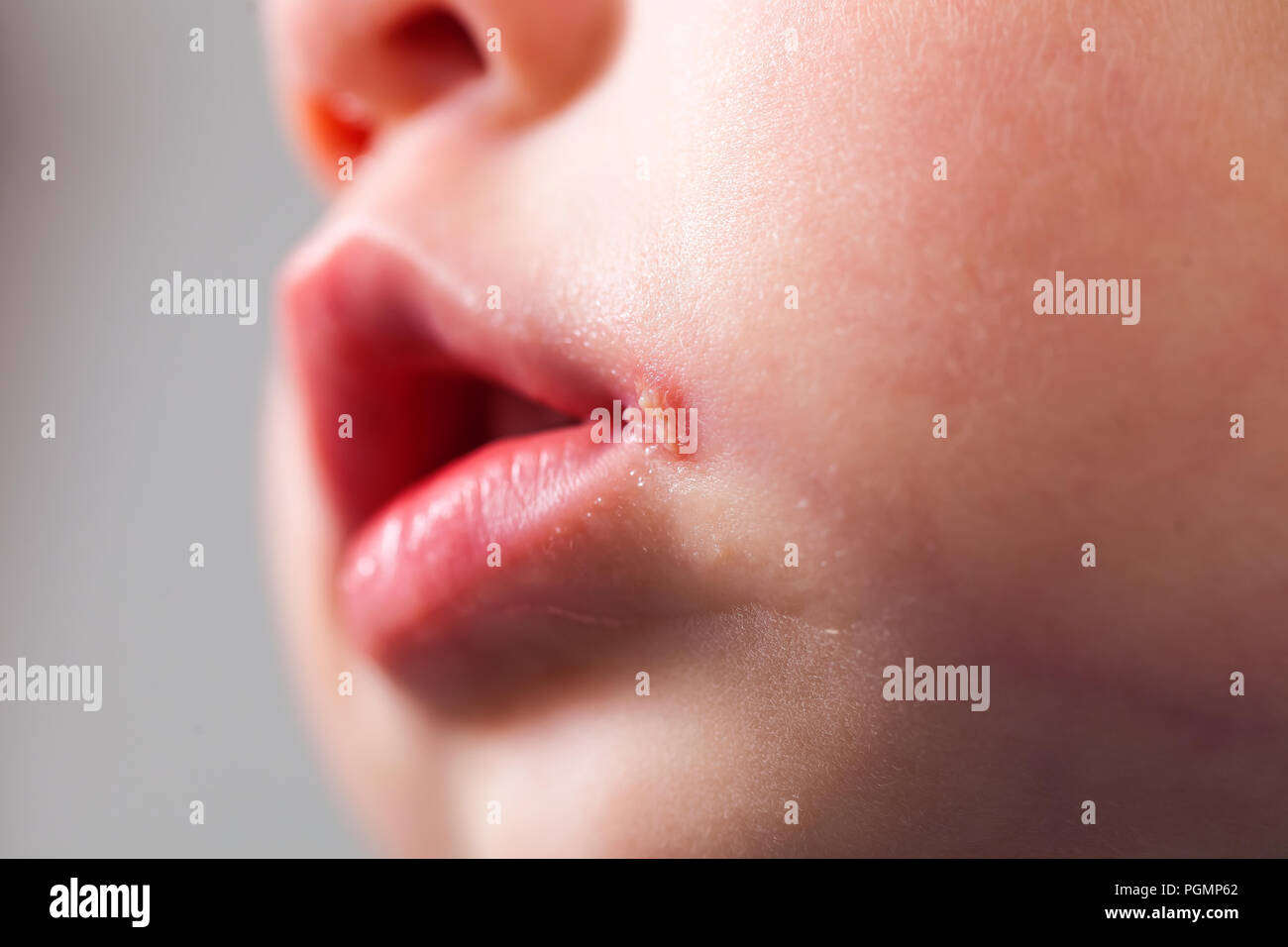 sore on the lip of the child . herpes Stock Photo - Alamy