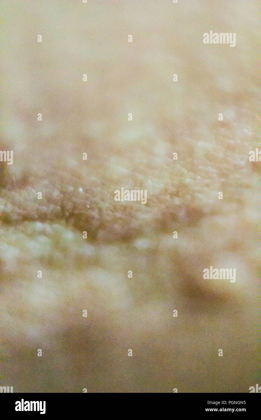 Close up view of cold urticaria allergic rash. Symptoms of itchy ...