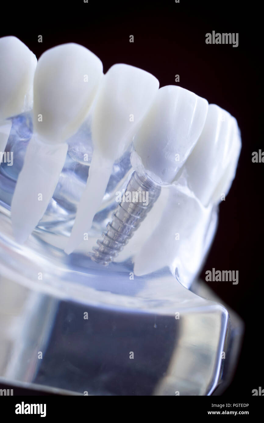 Dentist dental teeth teaching model showing titanium metal tooth ...