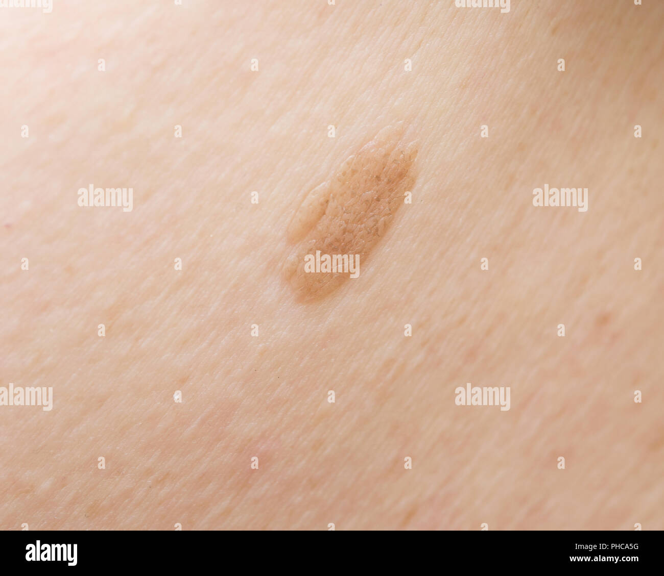 Birthmark hi-res stock photography and images - Alamy