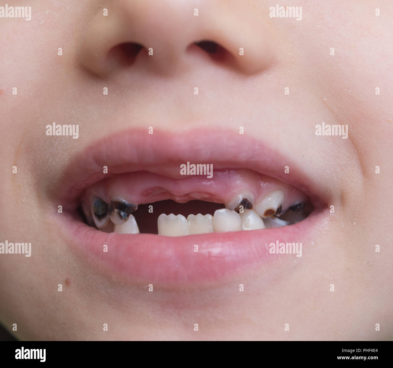 Baby tooth caries hi-res stock photography and images - Alamy