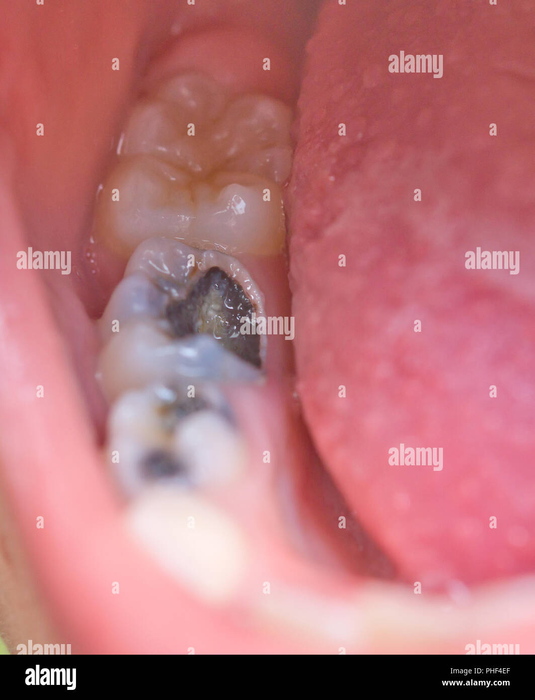 Tooth decay and child hi-res stock photography and images - Alamy