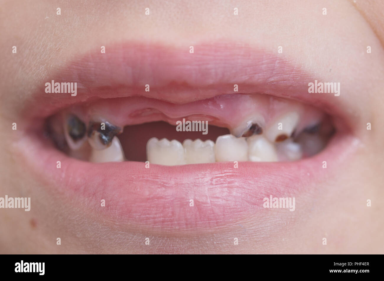 Rotten teeth baby hi-res stock photography and images - Alamy